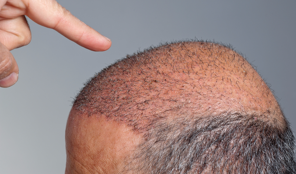 ¿Es el fin de la calvicie?